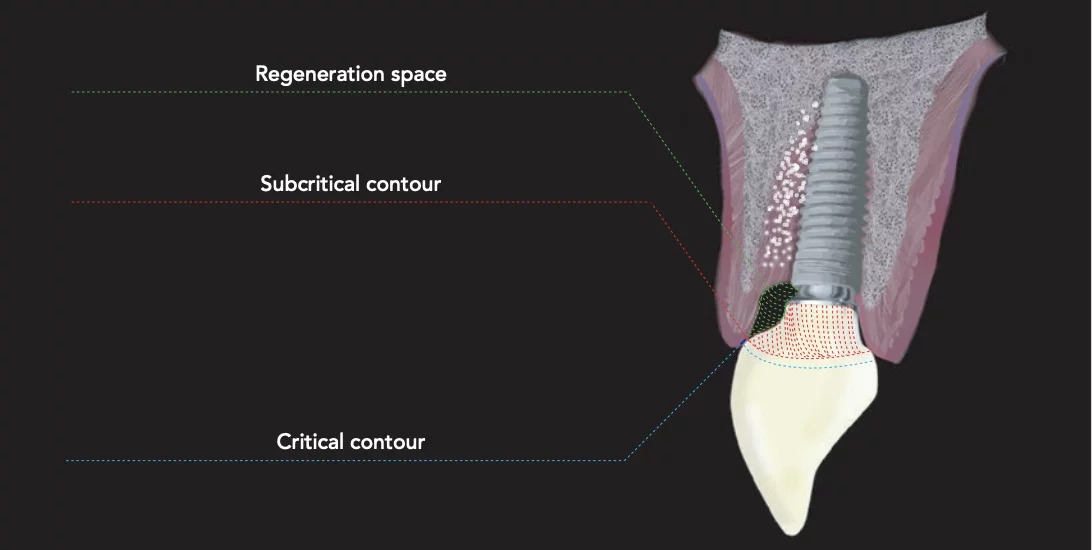 Gingival contour management of implant-supported restorations ...