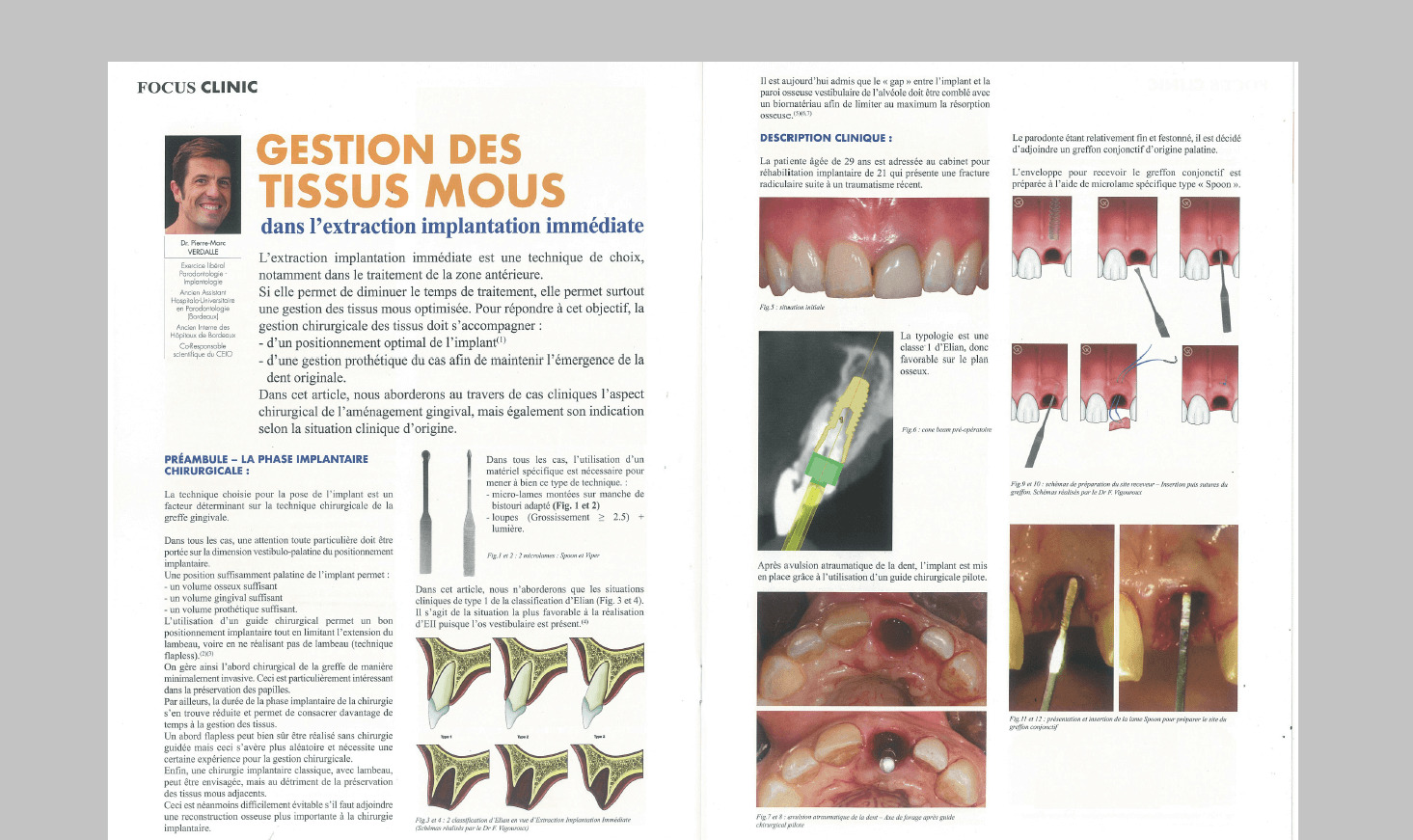 Soft tissue management in immediate extraction/implantation - iPhysio®