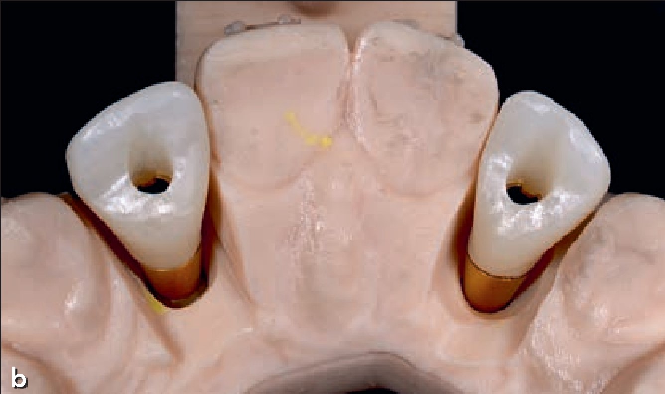 Clinical advantages of the socket shield technique in combination with ...