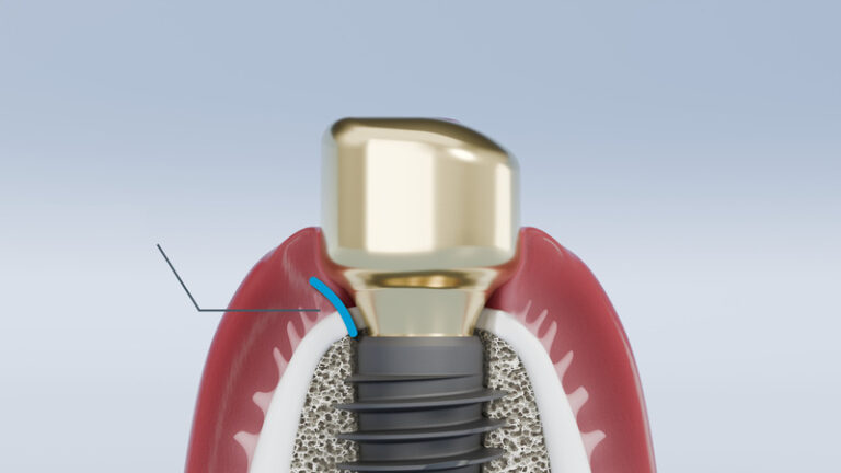 iPhysio®, the advanced implantology procedure