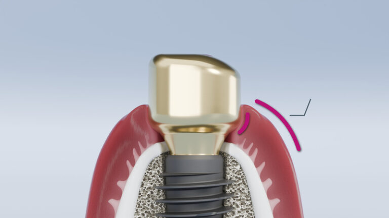 iPhysio®, the advanced implantology procedure