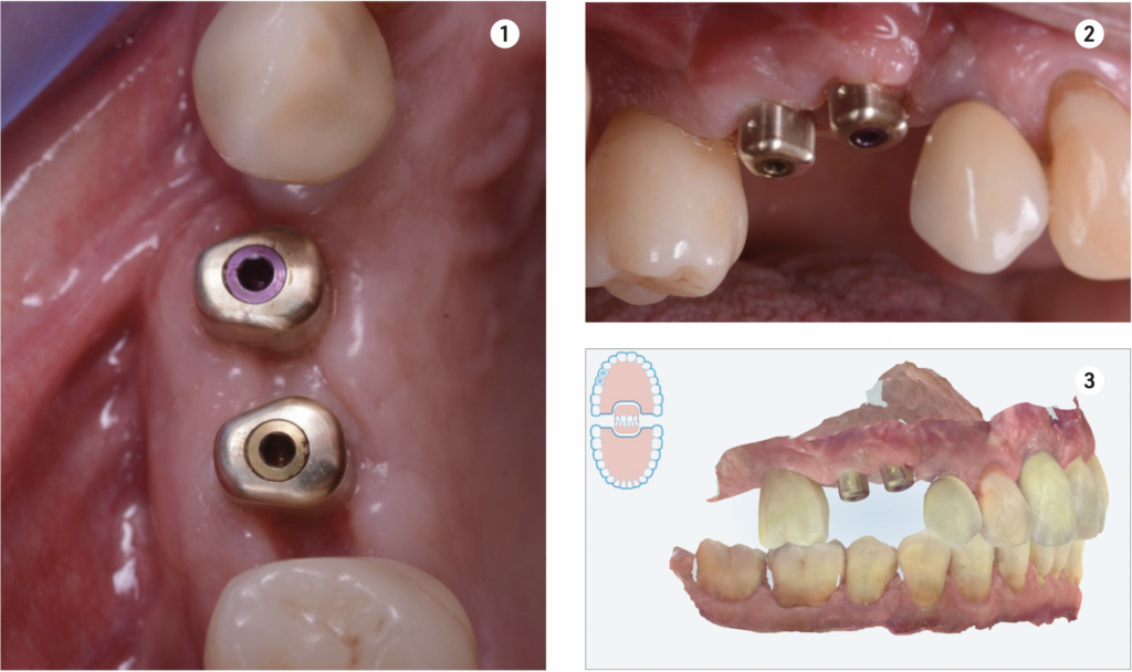 INFODENT - SIMPLE IMPLANT-PROSTHETIC REHABILITATION IN THE AGE OF 3D ...