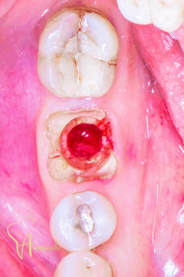 Immediate extraction and implantation in posterior area with the ...